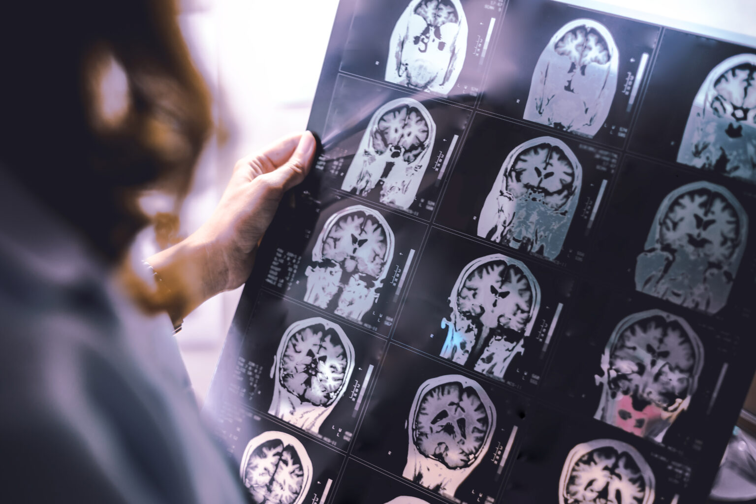 Tell me about white spots on brain ct scan – HelpDementia.com