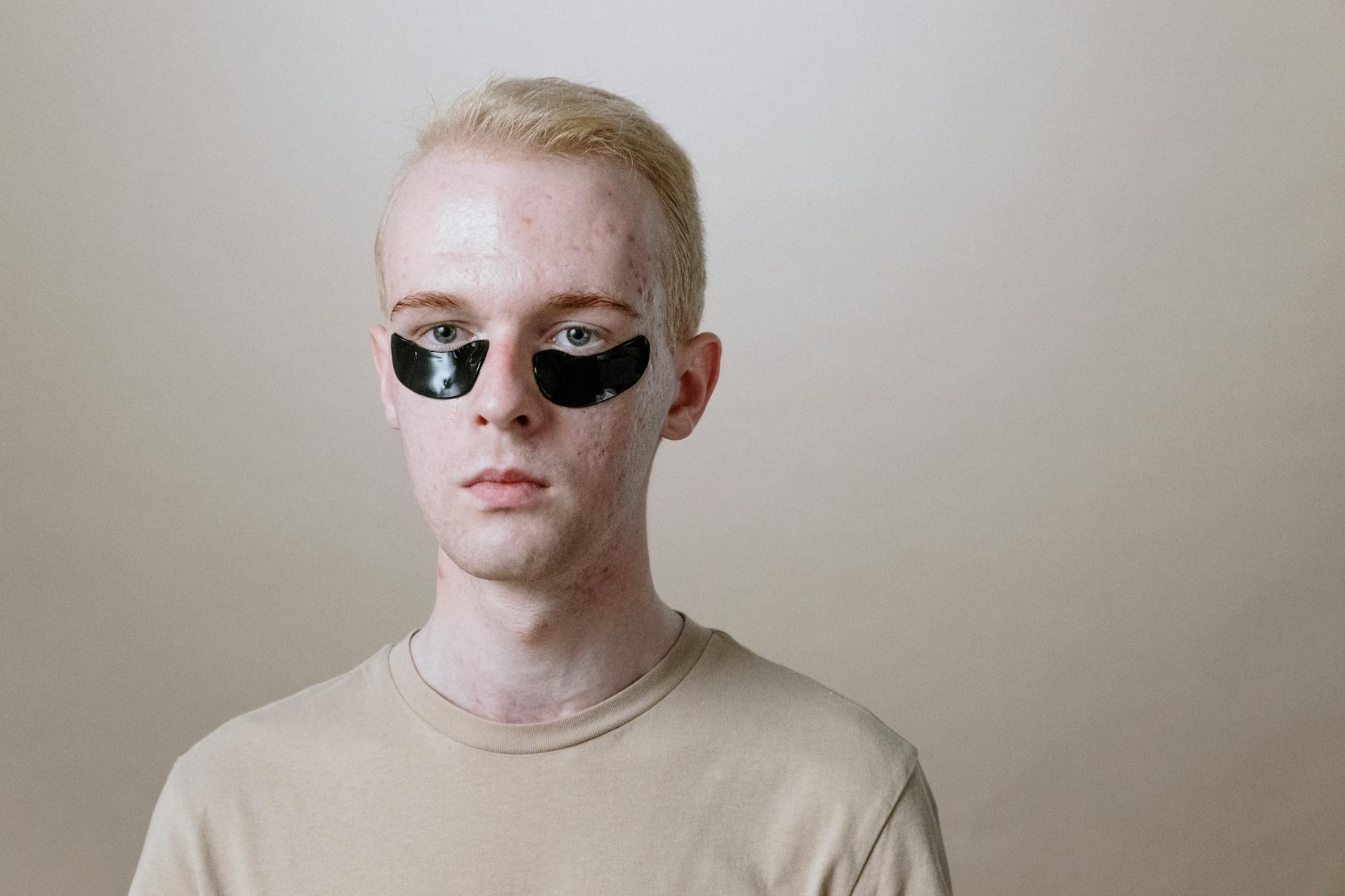 Acne Severity Grades Explained What Your Diagnosis Means - HelpDementia.com